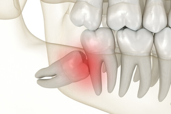 Wisdom Teeth Removal Cost: All You Need to Know
